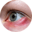Pink Eye (Conjunctivitis) Treatment Online - 24hrdoc